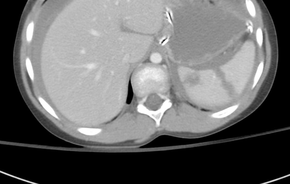 Splenic injury - by Alexander Baxter - RadNotes