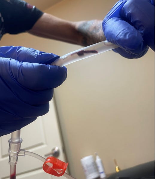 Patients Using EBOO/RHP/ Ozone Recirculatory Hemoperfusion Treatments ...