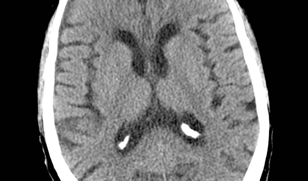 Subdural hygroma - by Alexander Baxter - RadNotes