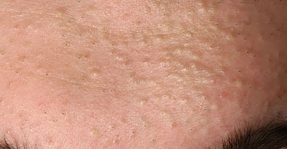 How to Get Rid of Closed Comedones - by Fawn B.