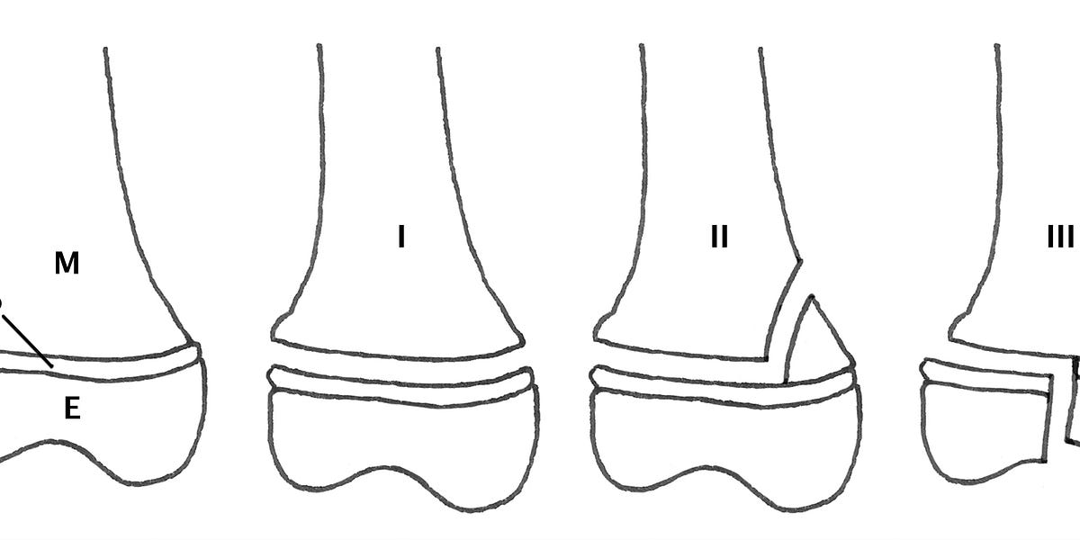 Salter Harris classification for pediatric fractures Salter Harris classification for pediatric fractures
