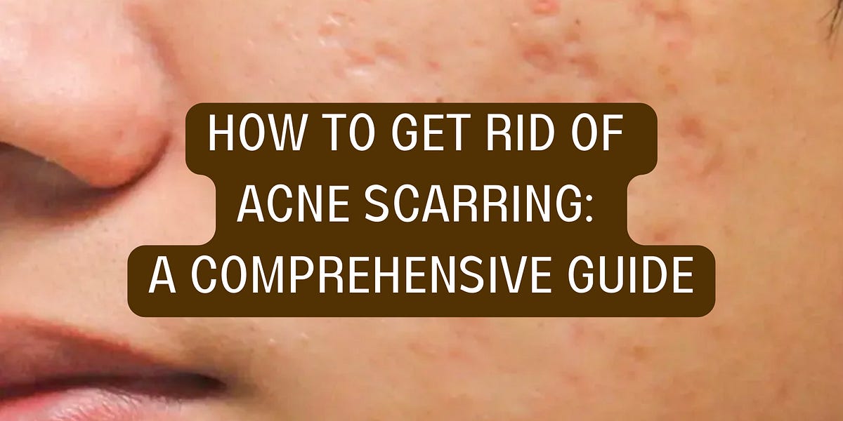 How to Get Rid of Acne Scarring: A Comprehensive Guide
