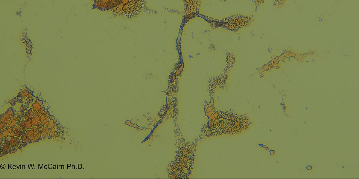 Amyloidogenic Fibrin Microclotting Following Prenatal mRNA Vaccination ...