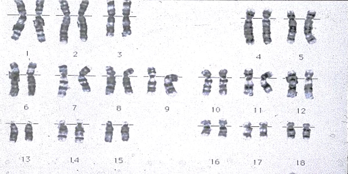 What's the diagnosis? - Flattened facial profile, head lag, single ...