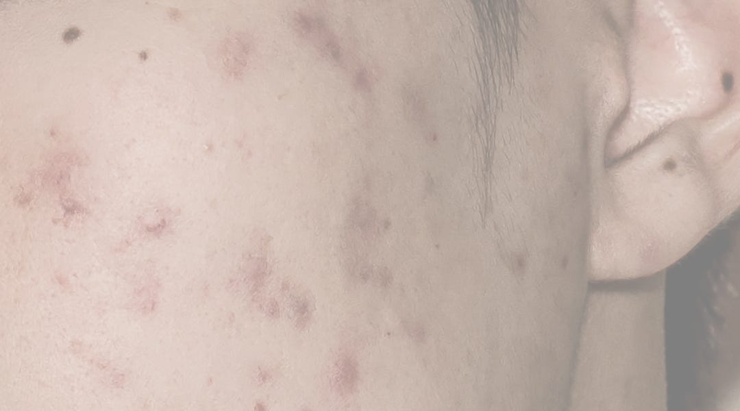 #3 Tackling Acne Part III - by The Skincare Provider