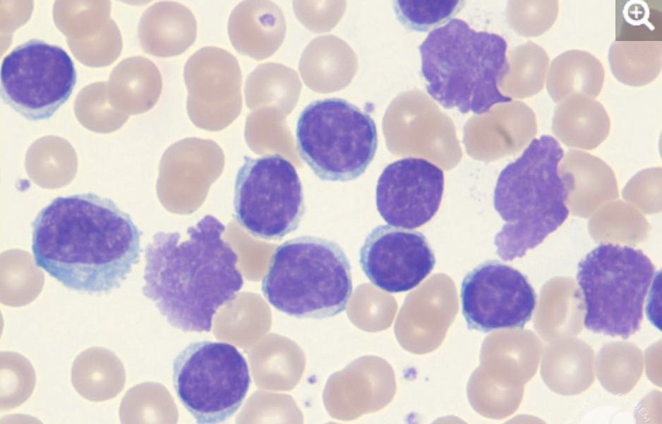 Blood Smear of the Day (3/8/23)