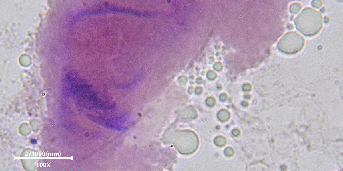 Gram staining of my blood reveals same abnormalities shown by ...