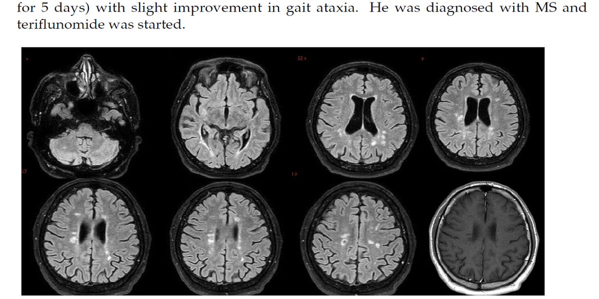 New-Onset and Flares of Multiple Sclerosis are Associated with SARS-CoV ...