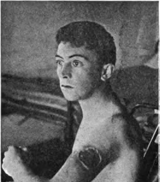 The Story of Smallpox and Vaccination