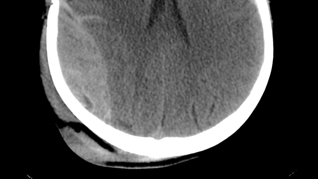 Epidural Hematoma - by Alexander Baxter - RadNotes
