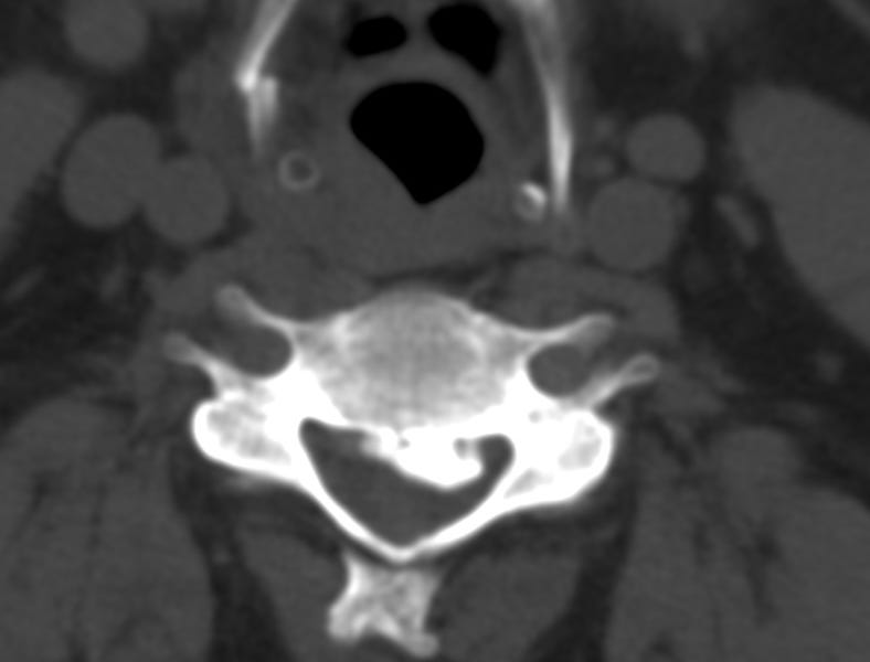 Laryngeal fracture - by Alexander Baxter - RadNotes