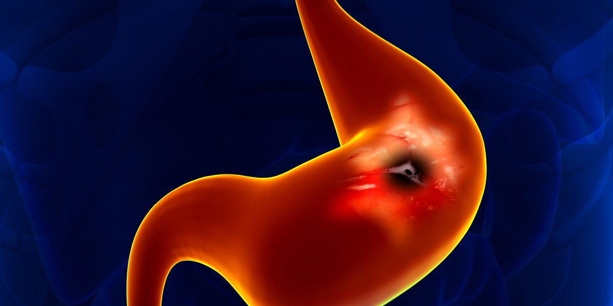 Stress ulcer prophylaxis in the ICU: Review - PulmCCM