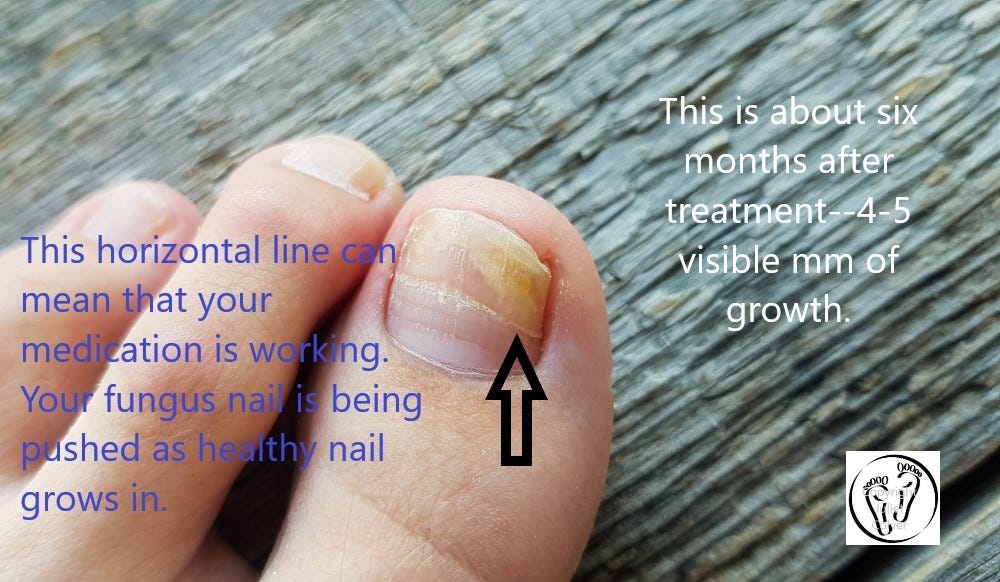 How Can I Medically Treat Toenail Fungus?