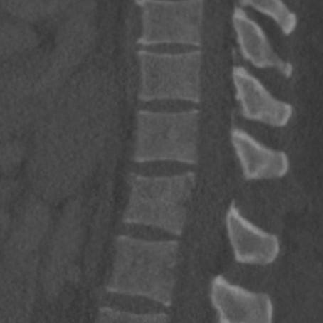 Spinal distraction injuries and dislocation