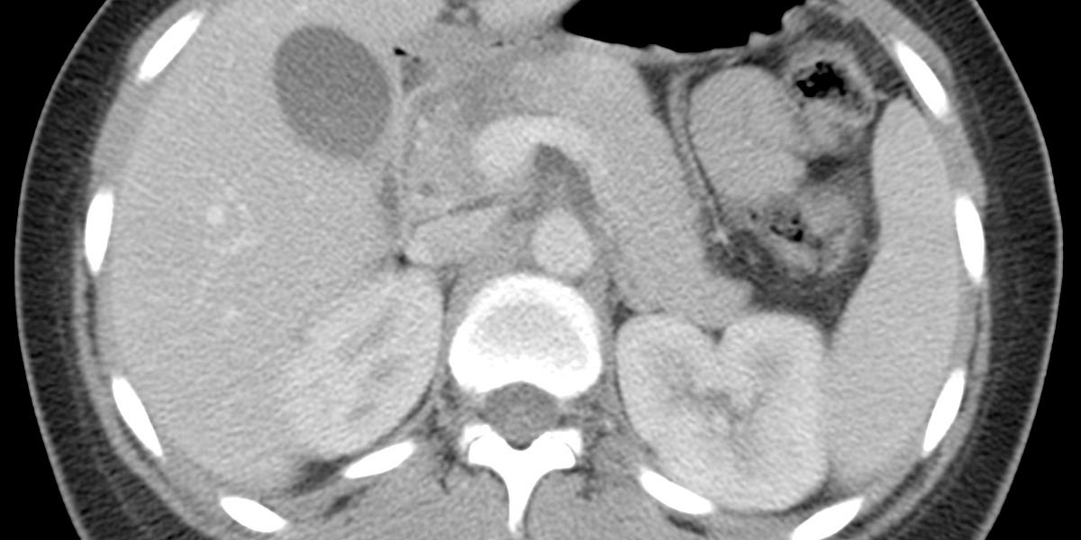 Traumatic Pancreatic Injury - by Alexander Baxter