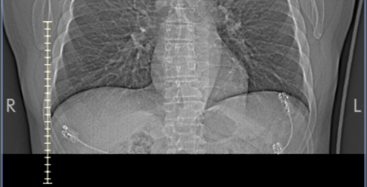 Comments - Cardiac Events - by Jason Heaton - SWIMPRUF