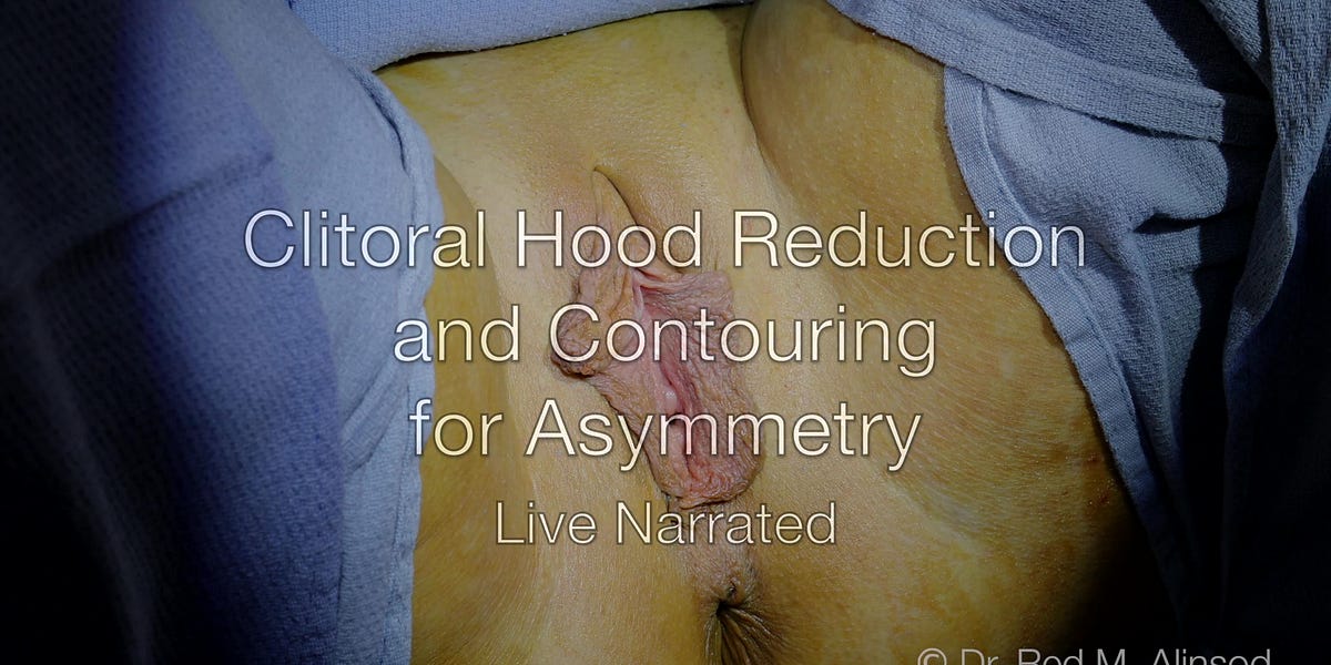 Clitoral Hood Reduction and Contouring, A Incisions for Severe Asymmetry