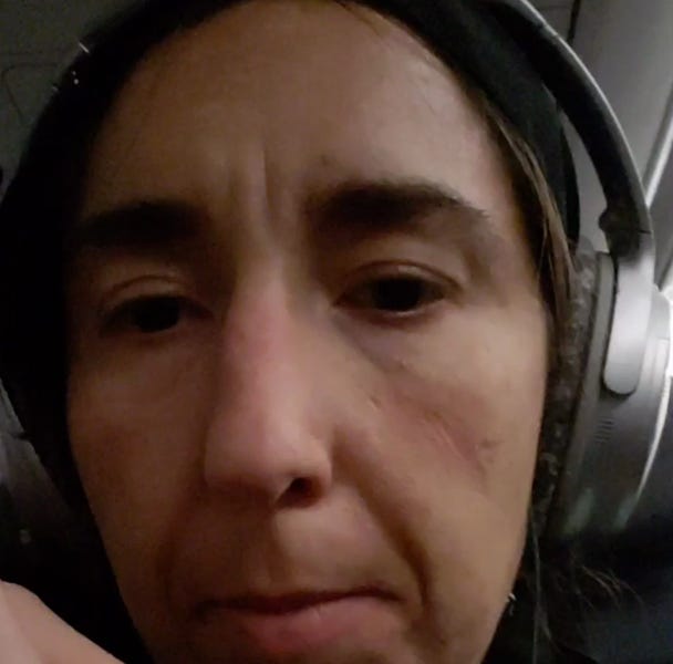 Vaginoplasty Volumes: The Blind Pouch Leading the Blind Pouch