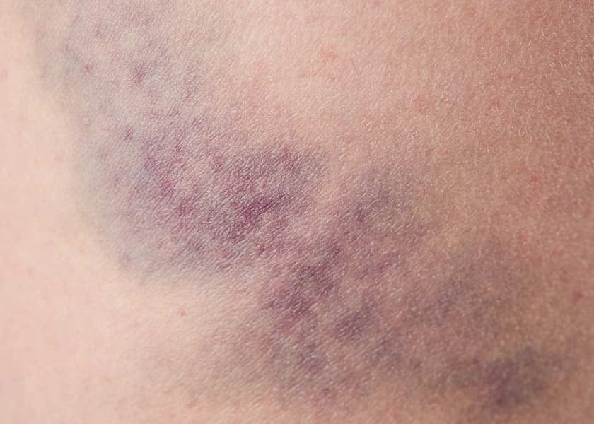 9 Reasons Why You Bruise Easily - by Dr. Joseph Mercola