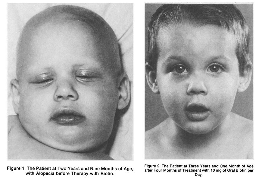 When High-Dose Biotin Is Truly Needed