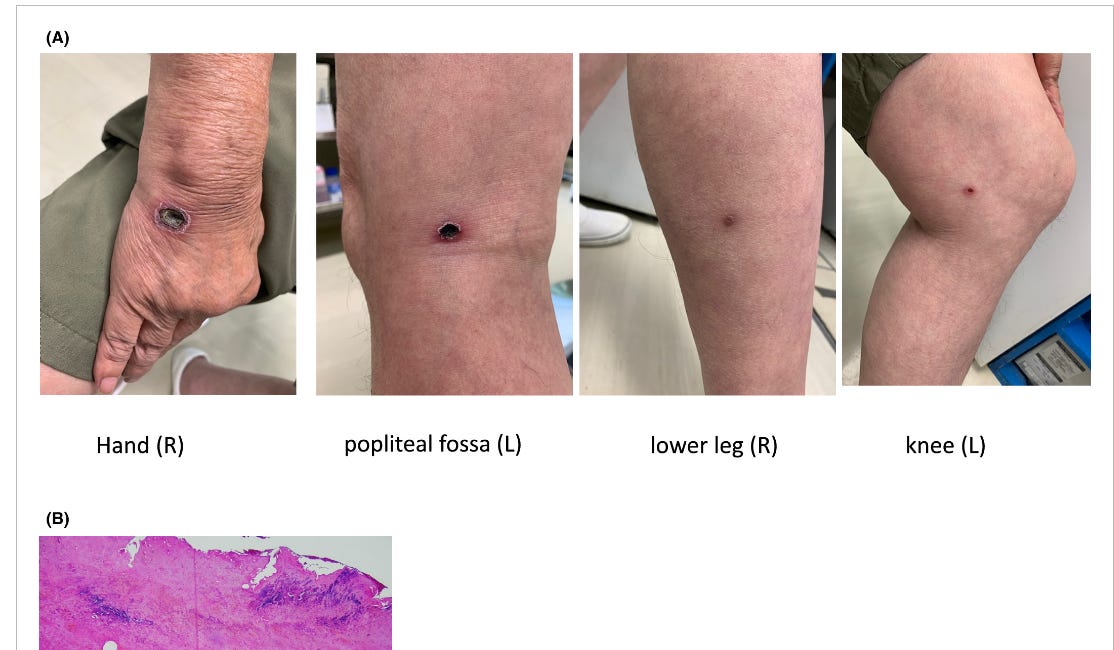 Update to Covid vaccines cause shingles: iCAN analysis of CDC vsafe data.