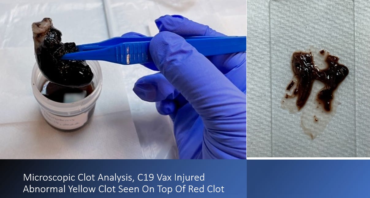 Comparison Microscopic Analysis Of Three C19 Vaccinated Blood Clots ...