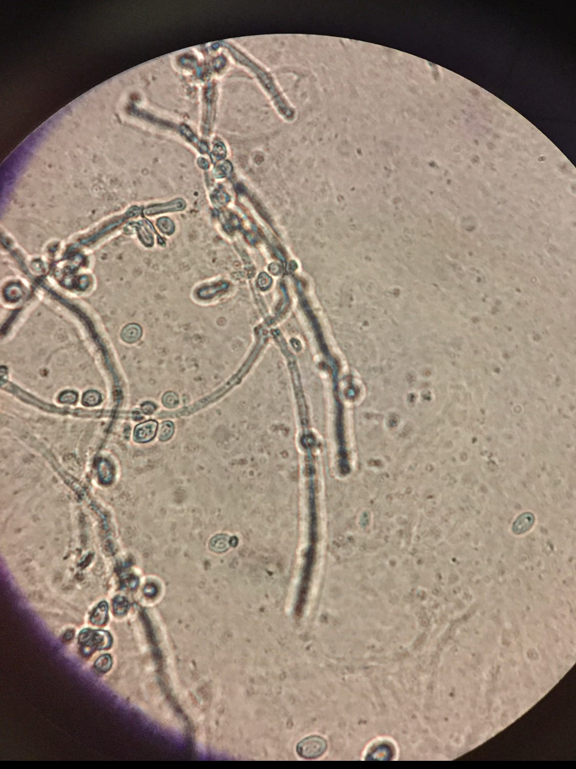 When a yeast infection won't go away - by Dr. Jen Gunter