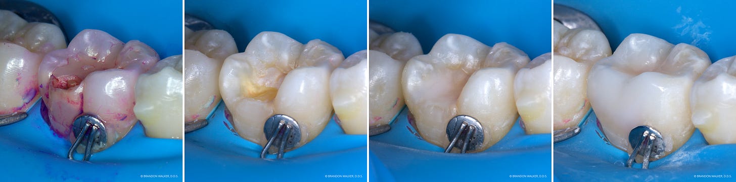 Bonding Better with Biomimetic Dentistry