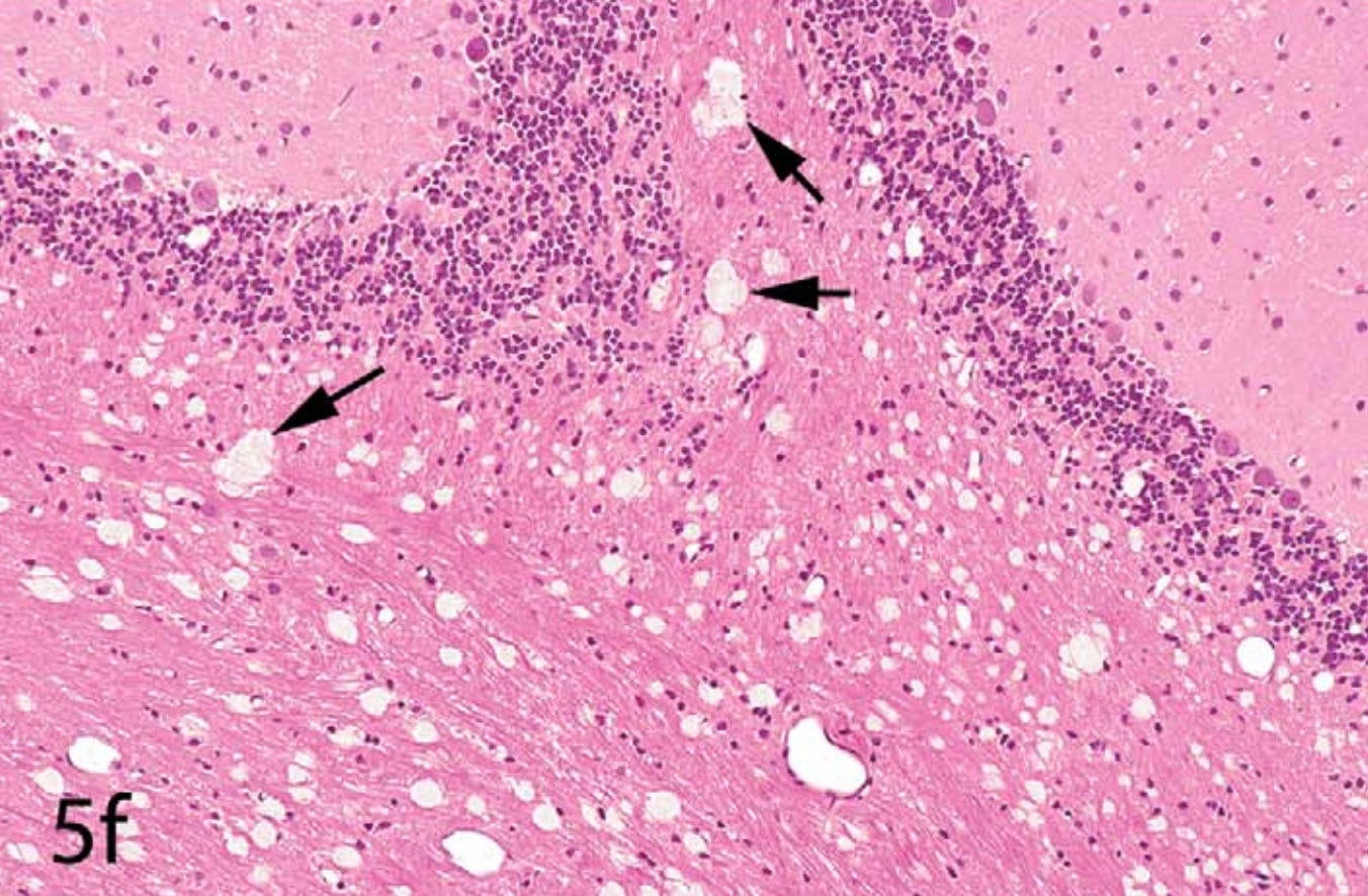 Removing the brain from the skull in brain banking: much more than you ...