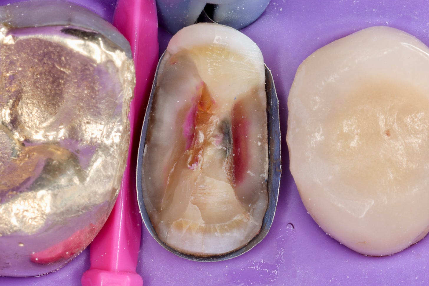 The "Liquid Dam" Technique - by Brandon Walker, D.D.S.