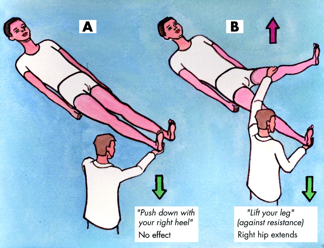 Hoover's sign - by Gavin Giovannoni - Teach Neurology