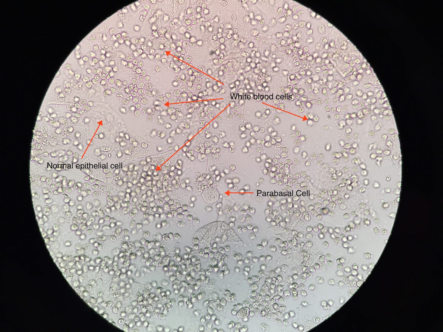 Desquamative Inflammatory Vaginitis - by Dr. Jen Gunter