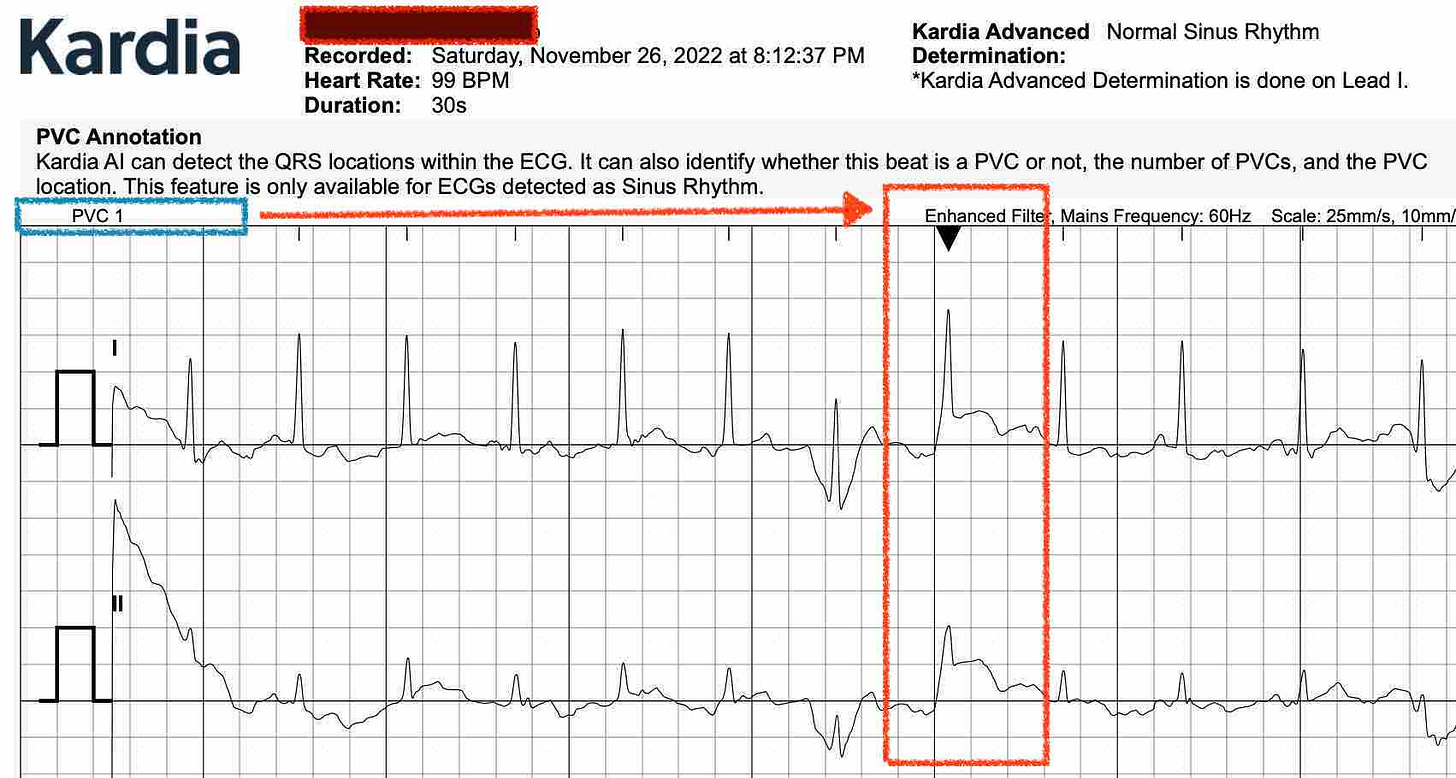 For Patients With Palpitations and PVCs Kardia's Determinations Can Be ...