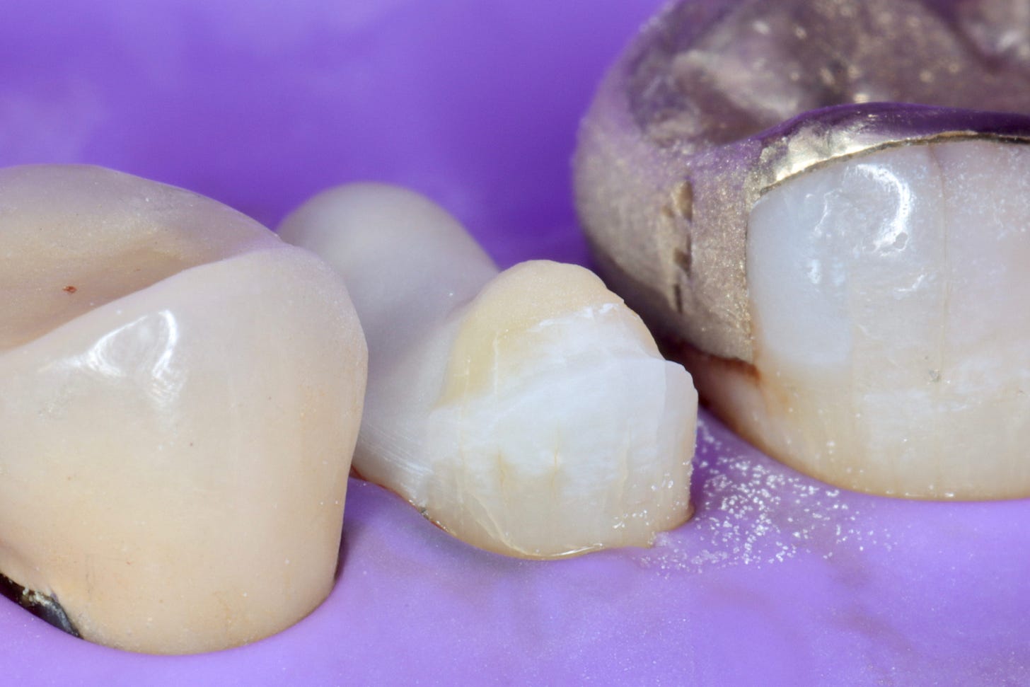 The "Liquid Dam" Technique - by Brandon Walker, D.D.S.