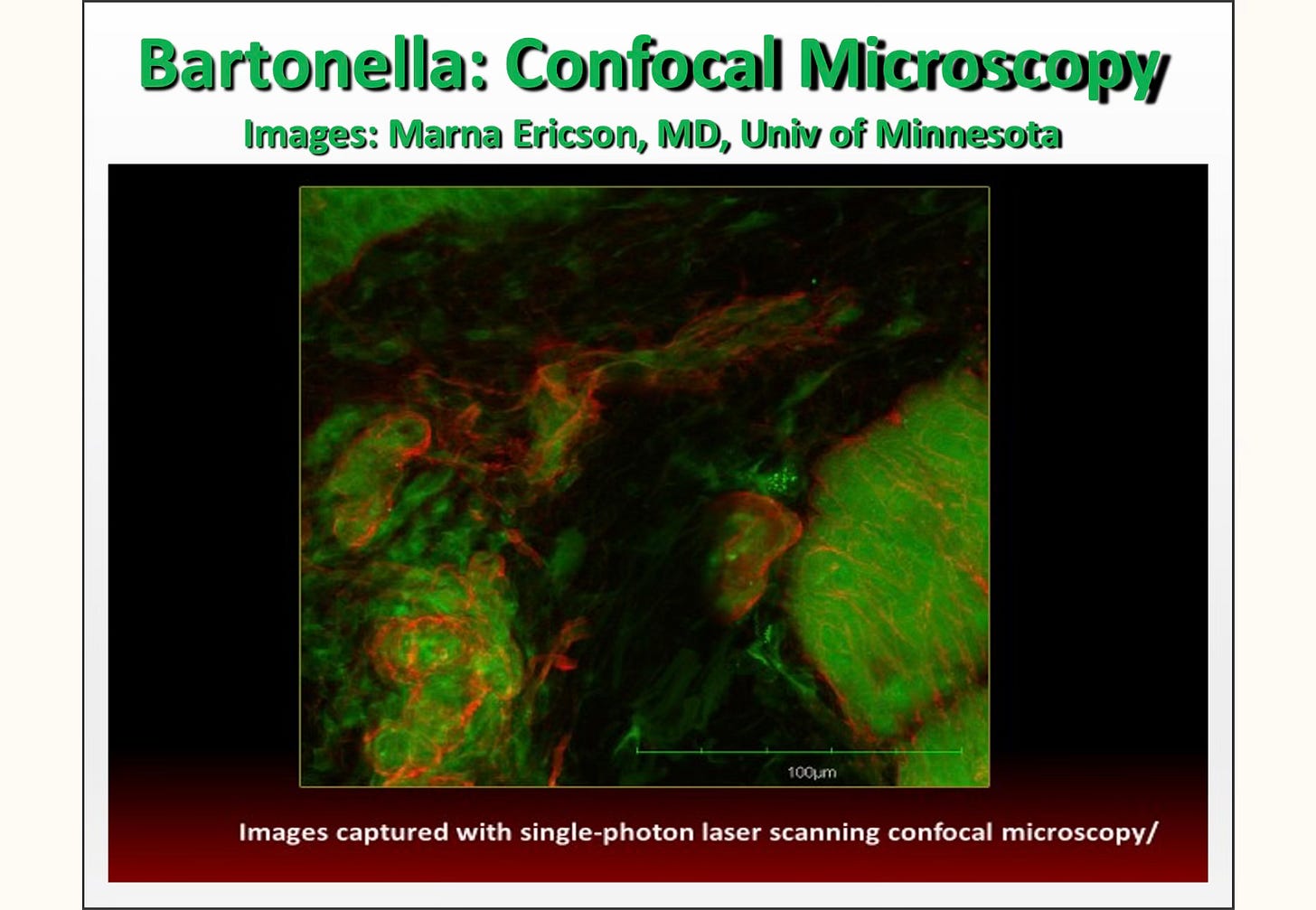 MEDICAL DETECTIVE: The complex role of Bartonella in chronic illness ...