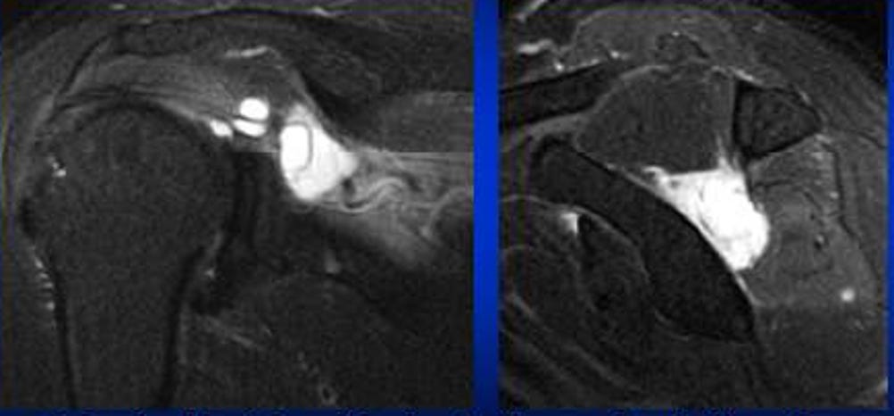 Neuropatia do supra-escapular - Causas, sitios de compressão e casos ...