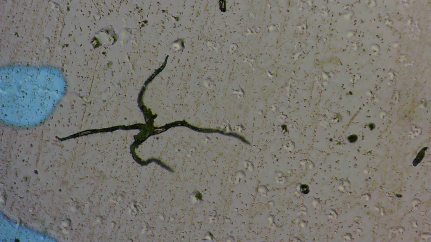 Morgellons Like Filament Tumor Found In Nasal Cavity With Insect ...