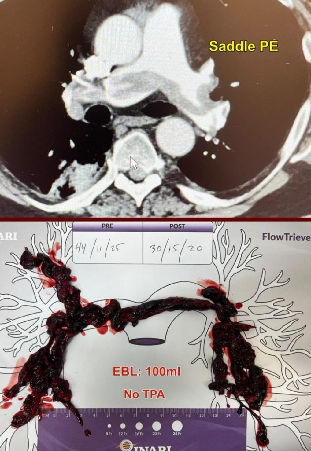 Dr. Phillip McMillan: Update on Embalmers Clots in the Living!