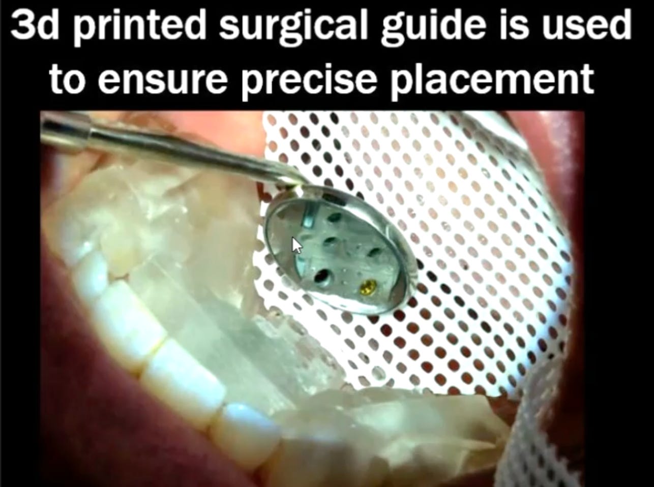 5.3 Top MARPE Devices Currently Available - JawHacks