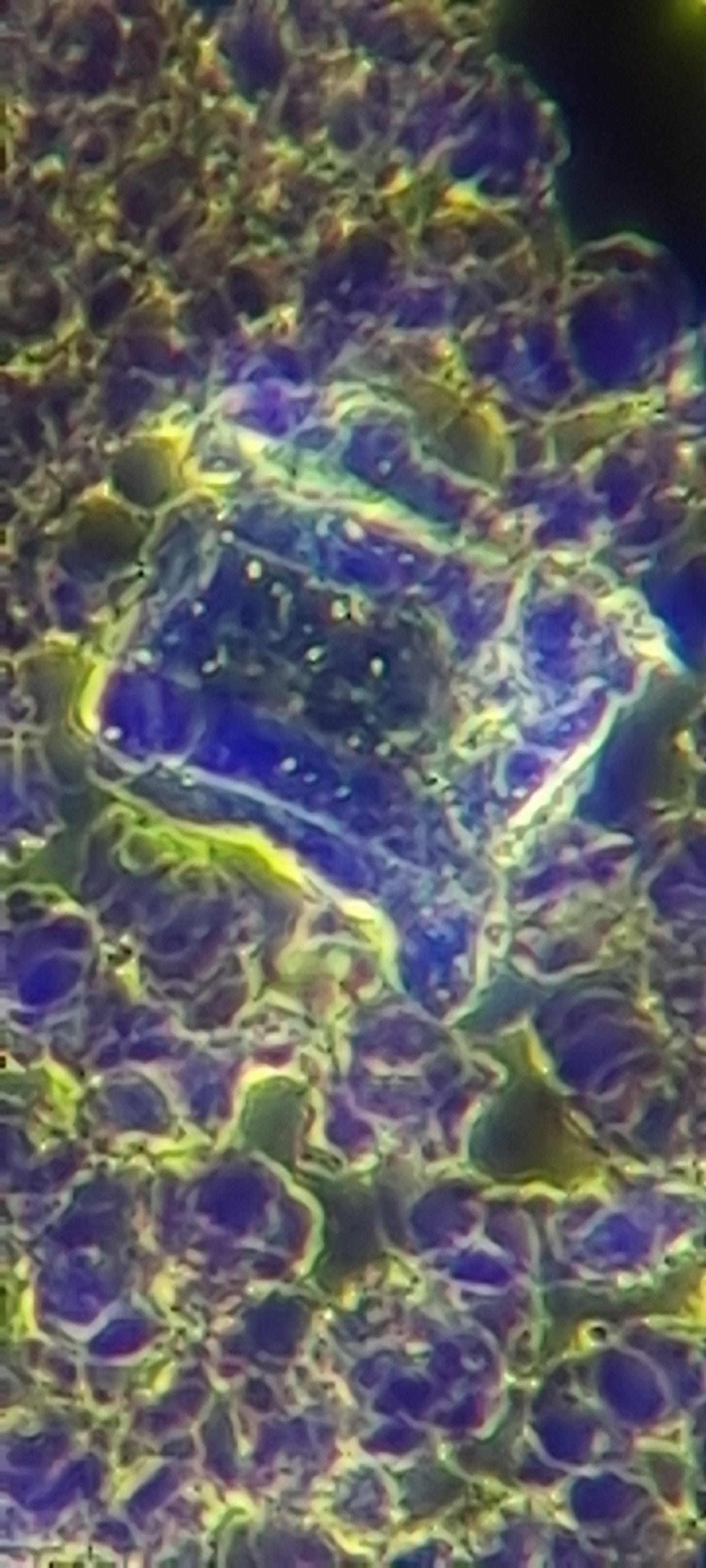 Exploding gel bubbles and WBC's, Glaucoma meds, bot breath and sundry.