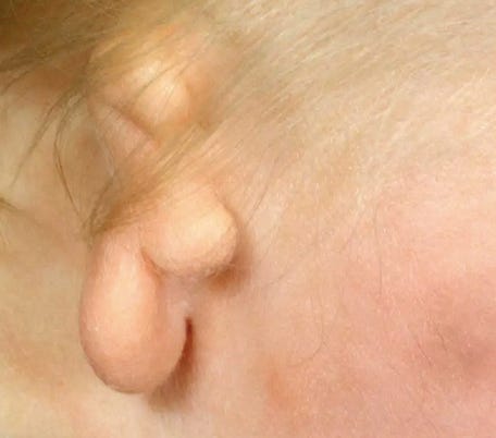 Pediatric Pearls: Infant's Ear - Pits, Tags, and the Pinna