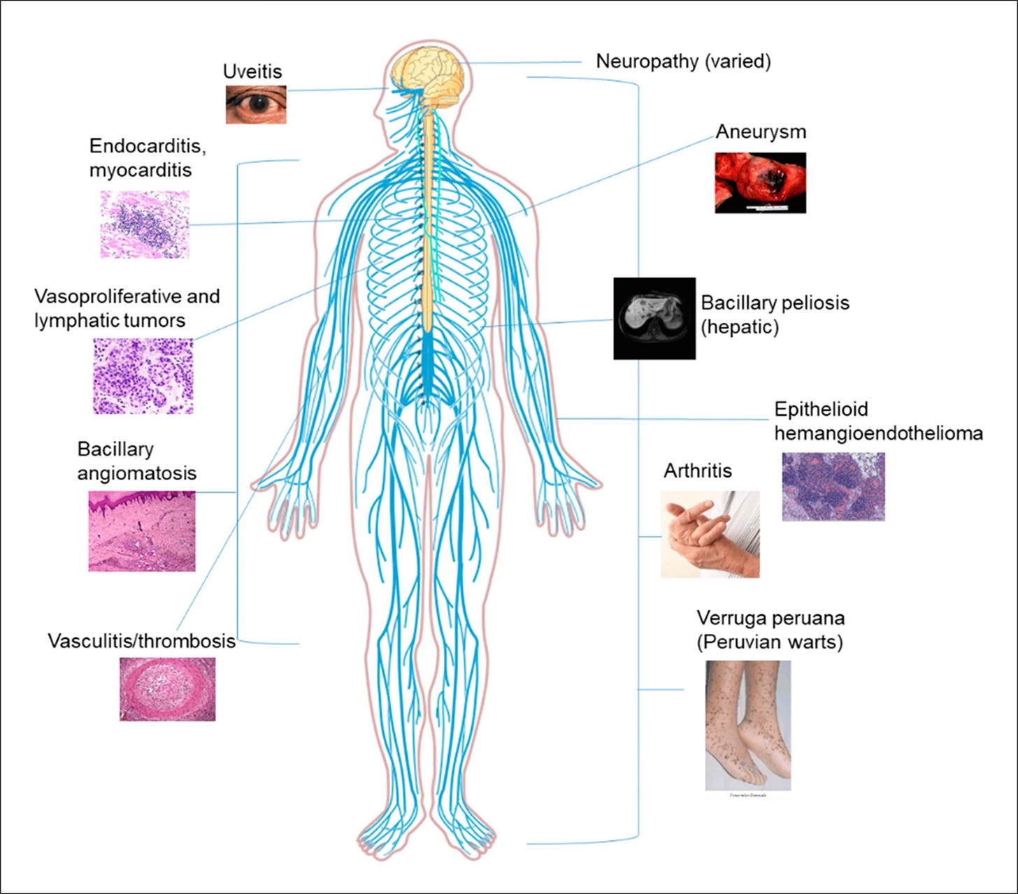 MEDICAL DETECTIVE: The complex role of Bartonella in chronic illness ...