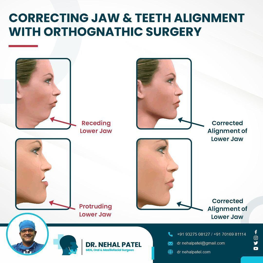 What is Prognathism? Identifying and Treating Jaw Alignment Issues