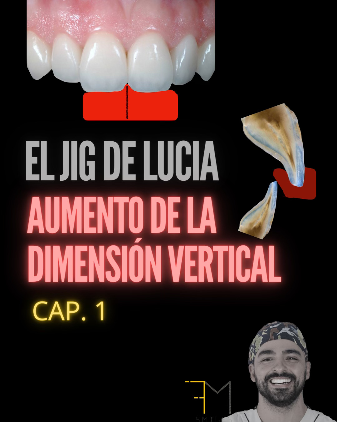 Aumento de la dimensión vertical Cap.1: El Jig de Lucia