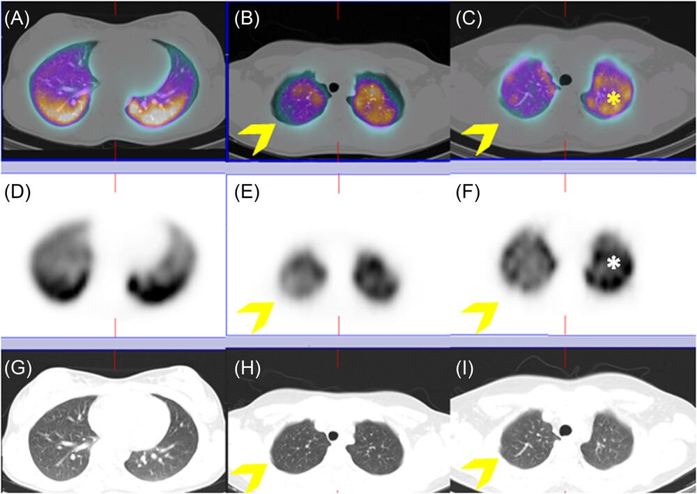 BACKSTAGE: Lung Hypoperfusion in children with Long Covid