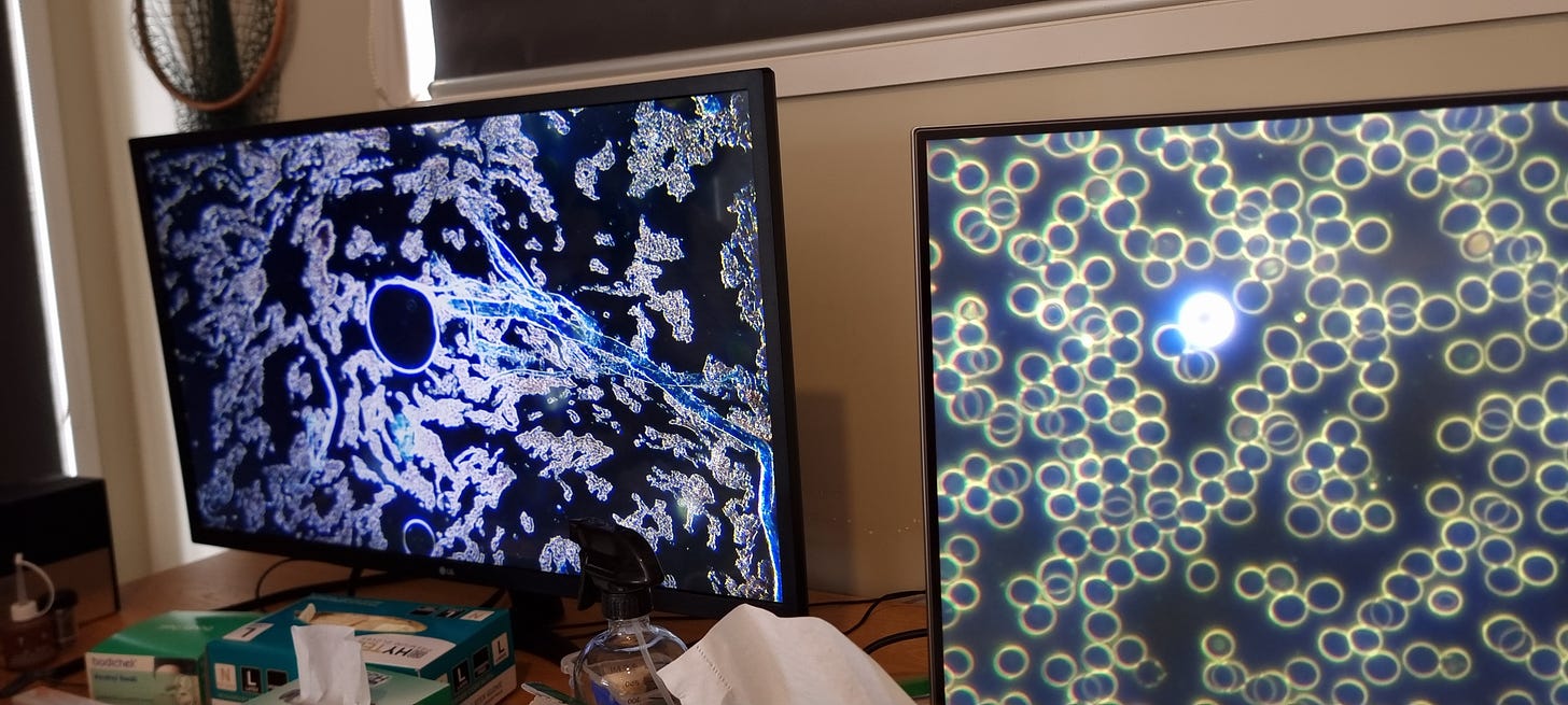 Exploding gel bubbles and WBC's, Glaucoma meds, bot breath and sundry.