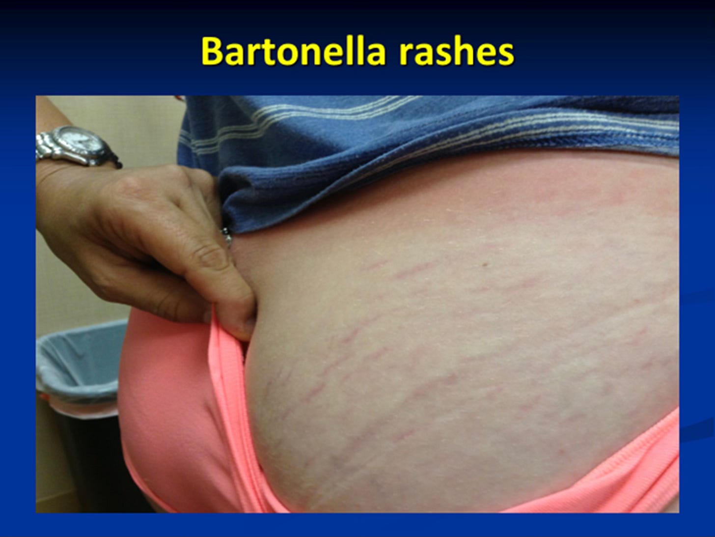 MEDICAL DETECTIVE: Establishing the diagnosis of Bartonella