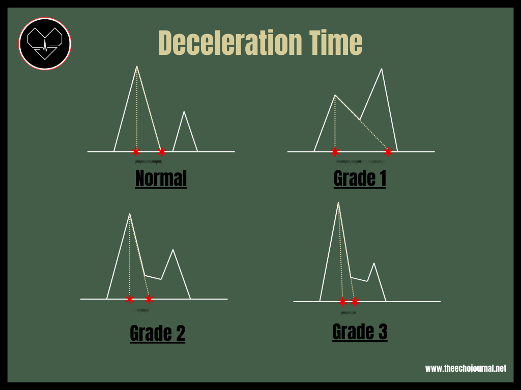 Diastology: The Meaning Behind The Waves - by Aram K.