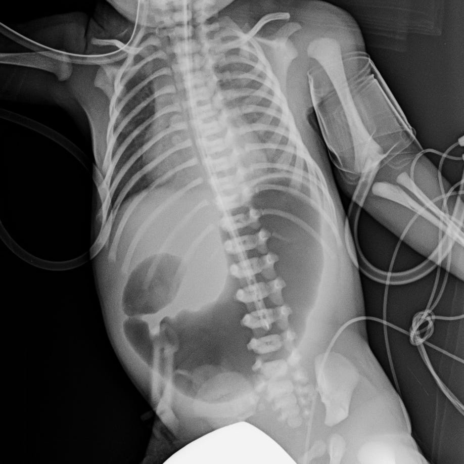 Duodenal atresia - by Alexander Baxter - RadNotes