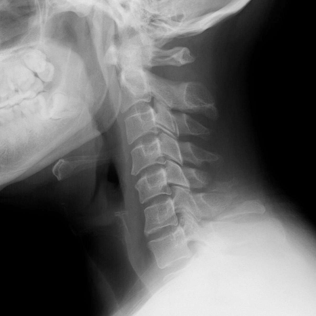 Cervical Spine Hyperflexion Injuries - by Alexander Baxter